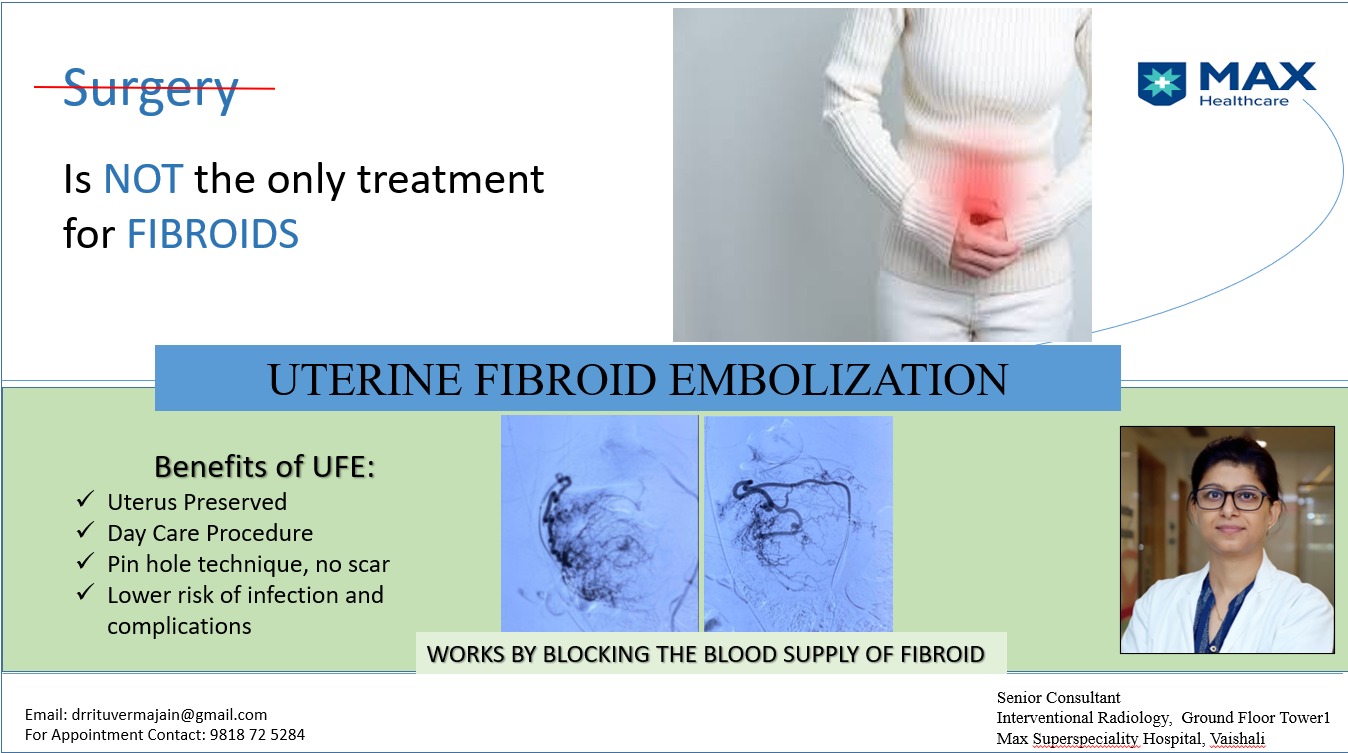 Understanding Uterine Fibroid Embolization - A Comprehensive Guide by ...
